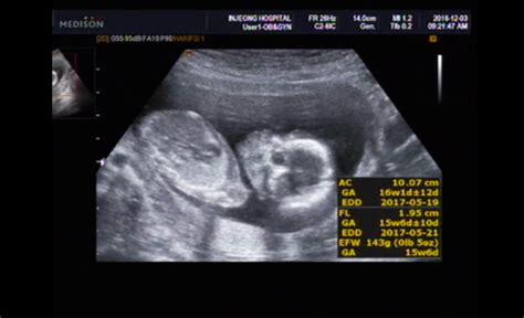 쌍둥이 임신 15주 성별확인 네이버 블로그