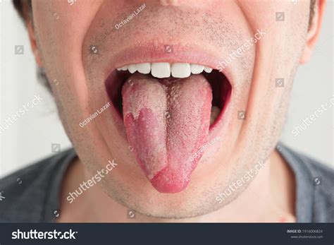 Tongue Yeast Infection In Men