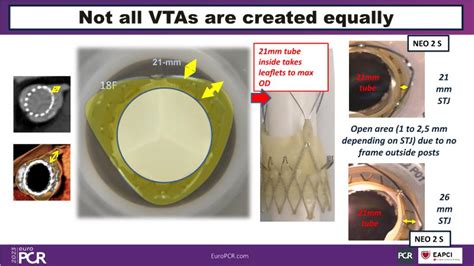 Redo Tavi And Patient Pathway Optimisation Lifetime Management Decisions Today For Challenges