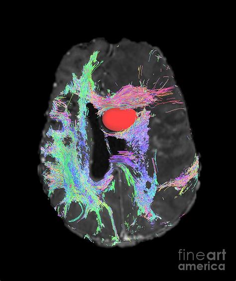 Brain Tumour Dti Mri Scan Photograph By Sherbrooke Connectivity Imaging Lab Pixels