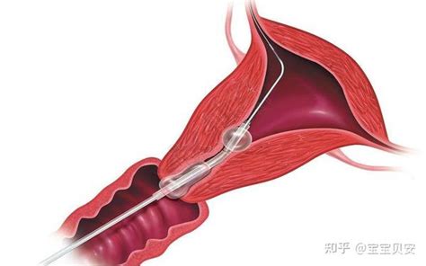 输卵管造影对身体有影响吗 知乎