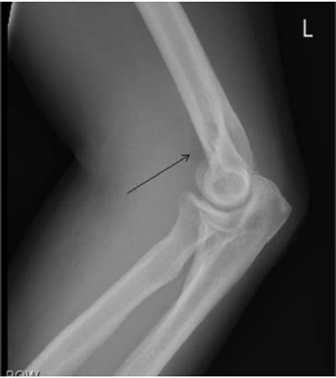 No Obvious Sign Of Fracture In Elbow A Discreet Intra Articular Fluid Download Scientific