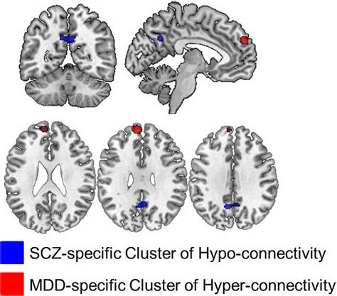 Disease Specific Clusters Of Aberrant Connectivity In The Default Mode Download Scientific