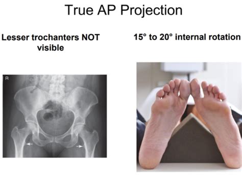 Rad 112 Lab Test Over Pelvis And Si Joints Flashcards Quizlet
