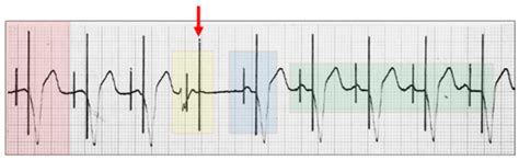 Dual Chamber Pacemaker Ecg Multiple Choice Questions Mcq