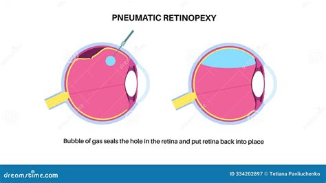 Pneumatic Retinopexy Poster Stock Vector Illustration Of