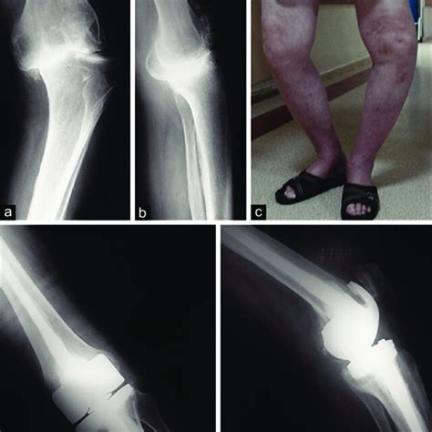 A And B X Rays Knee Joint Anteroposterior And Lateral Views Showing Download Scientific