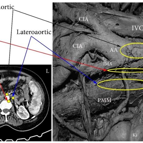 Left Lumbar Lymph Nodes Embalmed Cadaver Cia—common Iliac Artery
