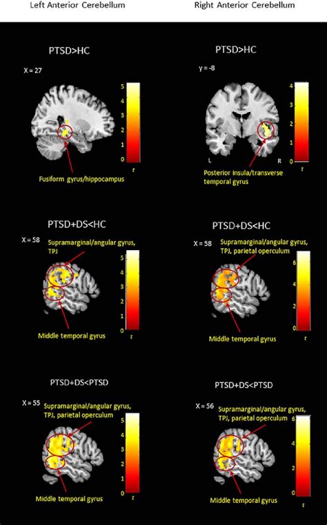 Fig Ure 2 Between Group Resting State Functional Connectivity Results