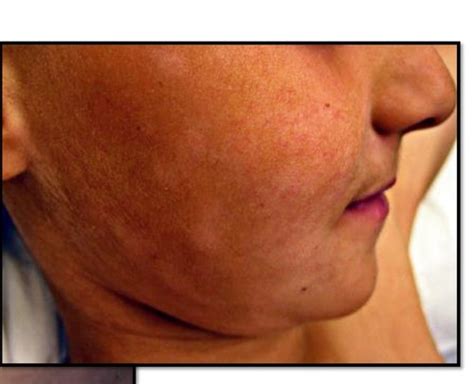 Dermatitis Lecture Flashcards Quizlet