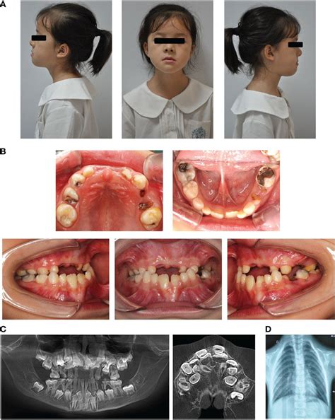 What Is Cleidocranial Dysplasia