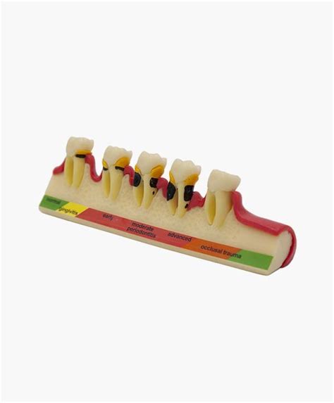 Periodontal Classification Model Soft Gingiva Feiman