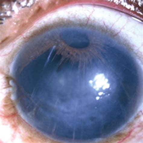 A Progressive Iris Atrophy Download Scientific Diagram