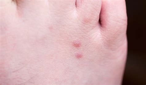 Identifying Bug Bites In Florida Images And Identification Native Pest Management