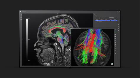 Diffusion Tensor Imaging Dti Fiber Tracking Imagilys