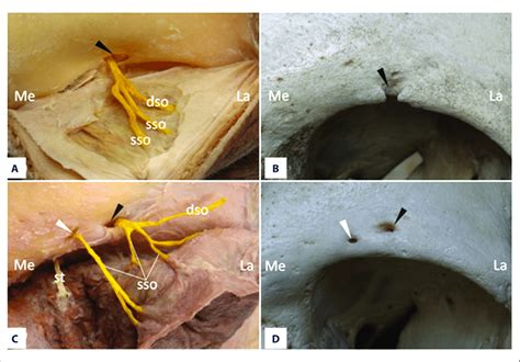 Anatomical Variations Of Notches And Foramina On The Supraorbital