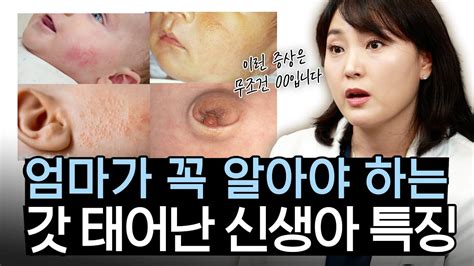 이 증상은 절대 놓치면 안됩니다 소아과 의사가 말하는 신생아 특징 태열 황달 육아종 피부 청력 시력 Youtube