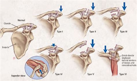 Mejores Tratamientos Para La Luxación Acromioclavicular Dr Ballester