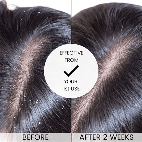 Buy Alevai Stem Cell Anti Dandruff Conditioner For Women And Men Itchy