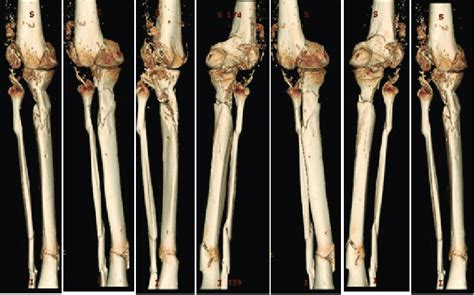 Twelve Month Post Operative Computed Tomography Scan 3d Reconstruction