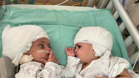 Conjoined Twins Joined At The Head Are Separated After 12 Hour Surgery In Israel Abc7 Chicago