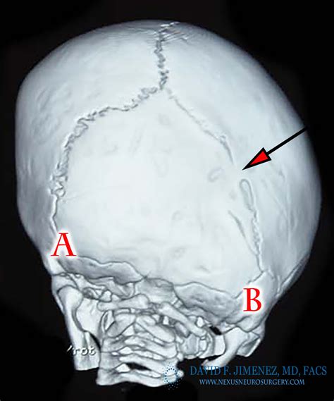 Lambdoid Suture X Ray