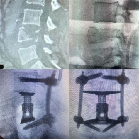 Mark A Prevost Ii On Linkedin L4 Lateral Corpectomy For Suspected