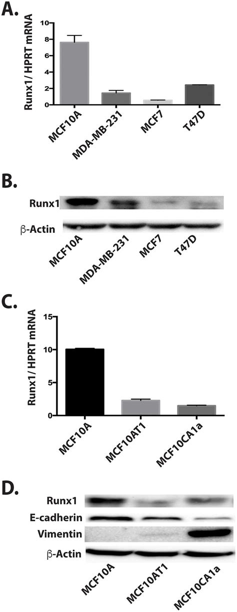 Decreased Runx1 Expression Is Related To Breast Cancer Progression In