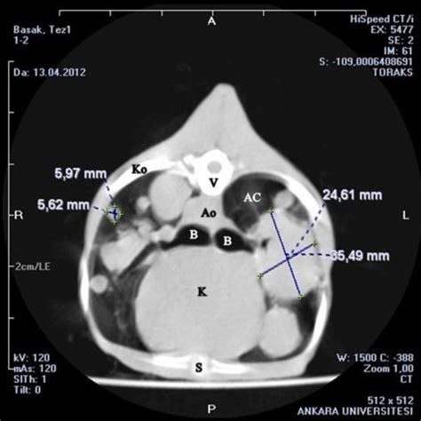 Transverse Ct Image At Thoracic Inlet Level In Patient Number 16 With Download Scientific
