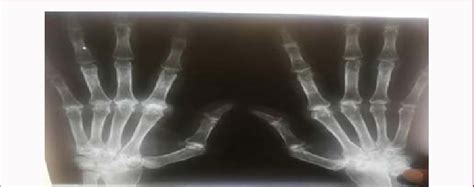 The Figure Shows The Ulnar Deviation In The Mcp Joints And Thumbs Download Scientific Diagram