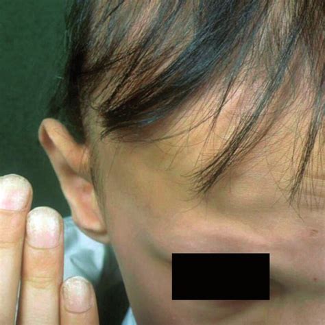 —alopecia Areata May Involve Hair And Nails Download Scientific Diagram