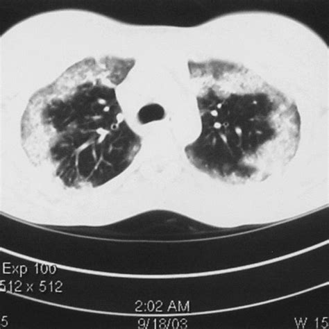 Chest Ct Scan 1 Day After Hospital Admission A Chest Ct Scan Shows Download Scientific Diagram