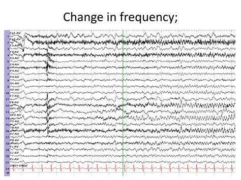 Recognition Of Abnormal Eeg Pptx