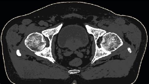 A Constructed Mri Based Pseudo Ct Image Of A Prostate Cancer Patient