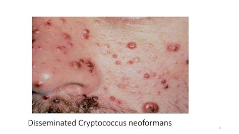 Cryptococcus Neoformans 1 Pptx