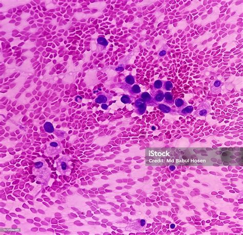 Lungs Adenocarcinoma Malignant Cell Smear Show Cellular Material Of