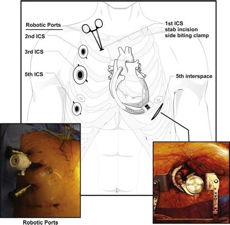 Placement Of Robotic Port Sites In Intercostal Spaces Ics And