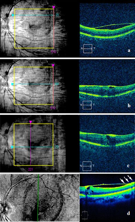 SD OCT Scan Of The Patient At Three Months SD OCT Scan Showed The ILM Download Scientific
