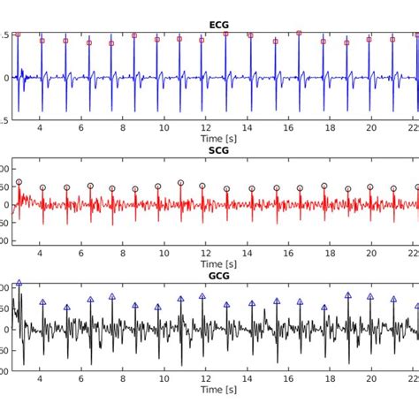 Poincaré Map Of Heart Rate Variability Hrv Calculated On Ecg Red Download Scientific Diagram