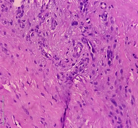 Tendon Sheath Biopsy Chronic Synovitis Smear Show Area Of Fibrosis And Infiltration Of