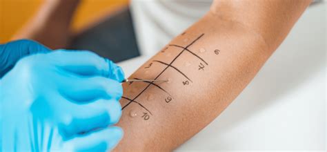 What Is Percutaneous Skin Testing