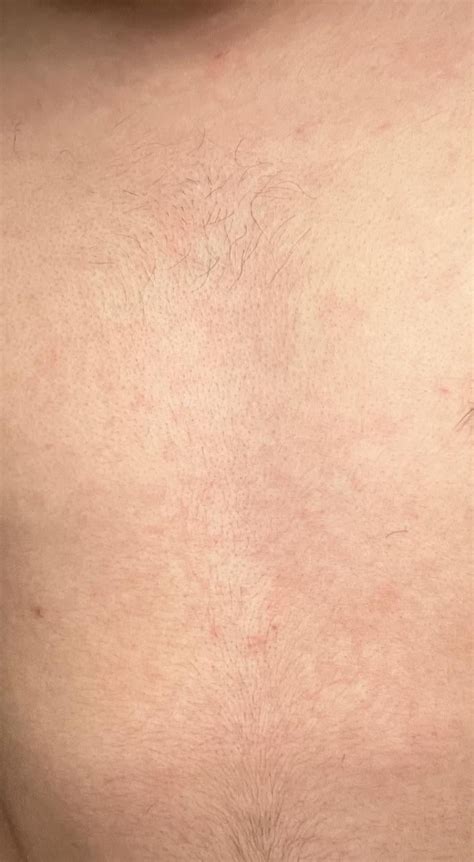 Is This A Rash If So What Type R Dermatologyquestions