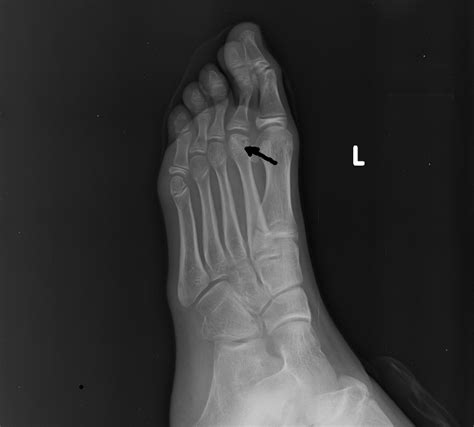 Ювенилна остеохондроза на втора метатарзална кост болест на Фрайберг Добре дошли в сайта на