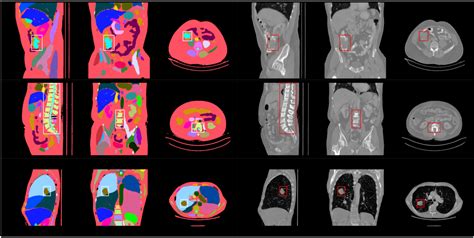 Addressing Medical Imaging Limitations With Synthetic Data Generation Nvidia Technical Blog