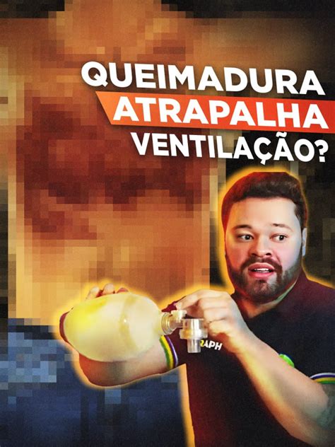 Paciente De Queimadura De 3 Grau Como Instituto Brasileiro De Aph