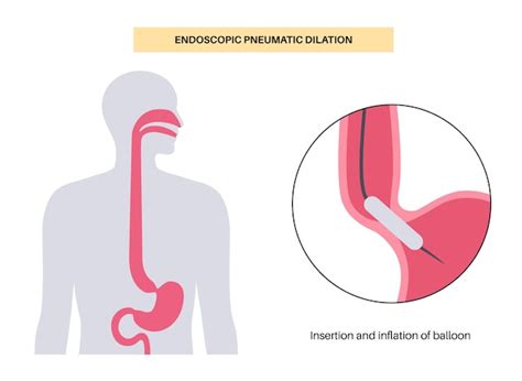 Premium Vector Endoscopic Pneumatic Dilation Upper Endoscopy