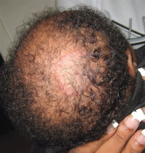 Ringworm Scalp Symptoms Causes Mayo Clinic OFF