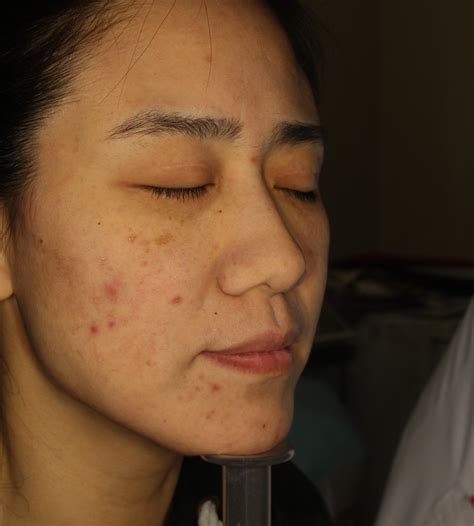 Acne04 Object Detection Model V1 2023 01 30 12 23pm By Andrei Dore