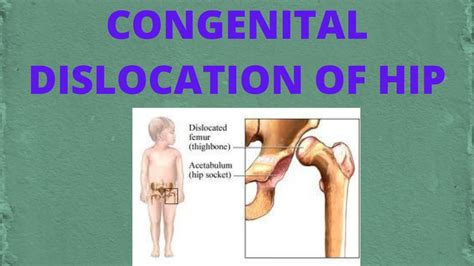 Congenital Dislocation Of Hip Pt Ortho Youtube