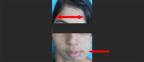 A Spectra Of Facial And Auricular Anomaly Brachial Arch Syndrome